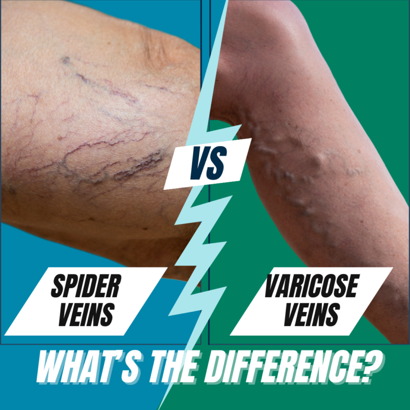 Varicose Veins vs. Spider Veins – Blue Rock Medical